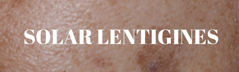 Solar Lentigines - Beautyologist