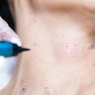 Cryotherapy Lesions and Skin Tag Removal Treatments in Melbourne, VIC