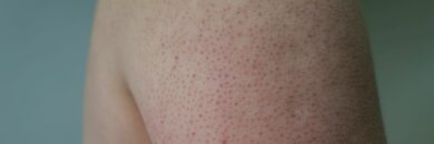 Keratosis Pilaris Treatment – (The reddish bumps on the back of the ...